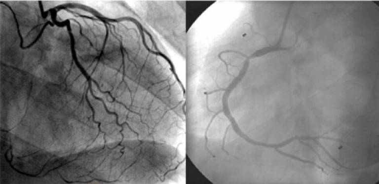 Le cœur - Chirurgie cardiaque - Clinique Saint-Augustin, Bordeaux