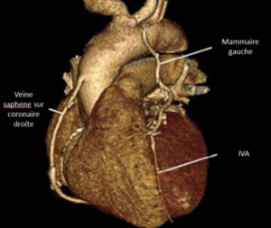 Pontages coronariens - Clinique Saint-Augustin, Bordeaux