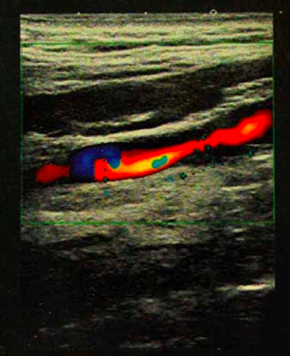 Opération de la carotide - Clinique Saint-Augustin, Bordeaux