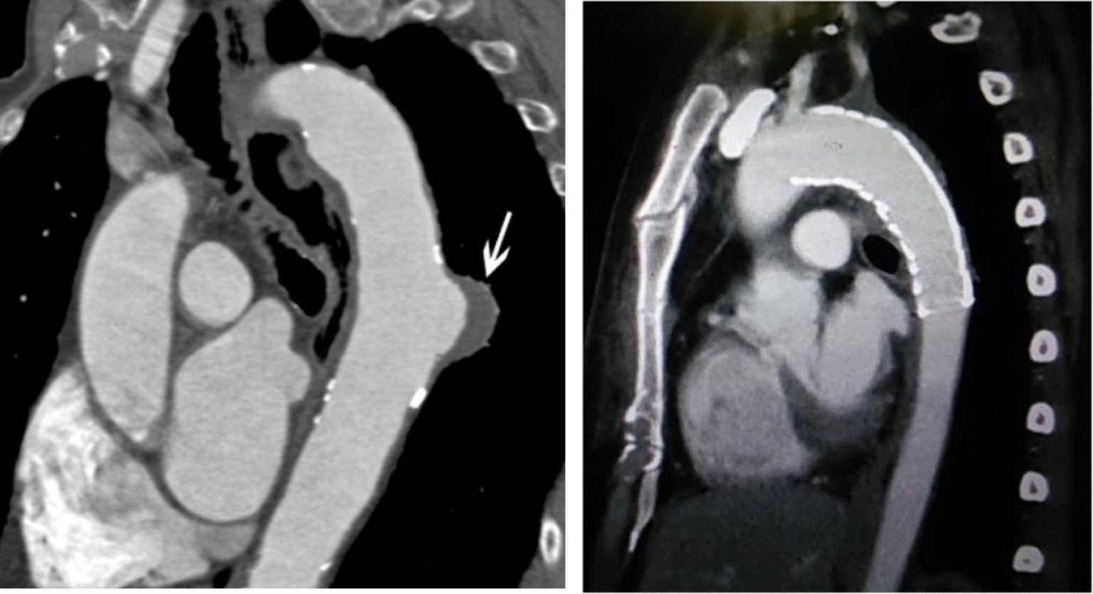 Aorte thoracique descendante - Chirurgie cardiaque